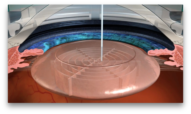 Femtosecond Cataract Surgery : Boulder Eye Surgeons
